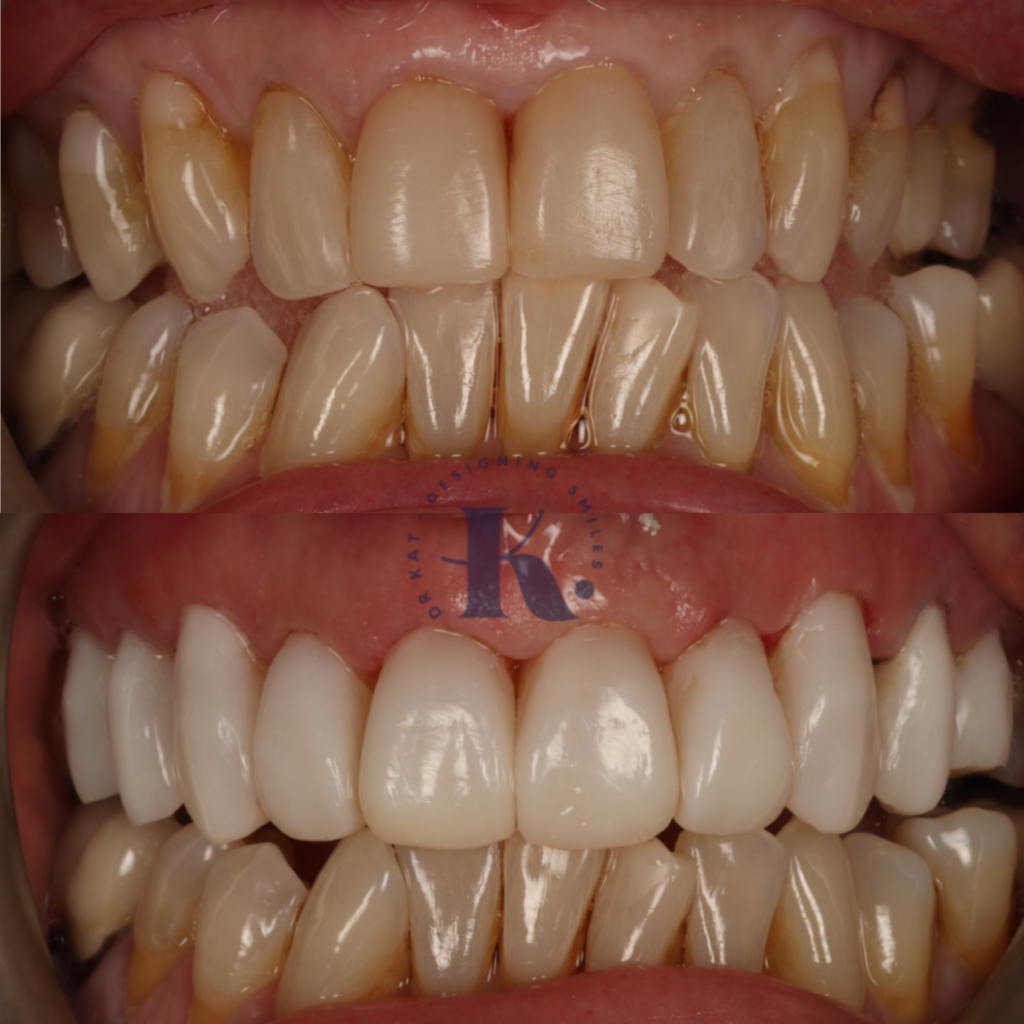 Composite Bonding Dr Kat